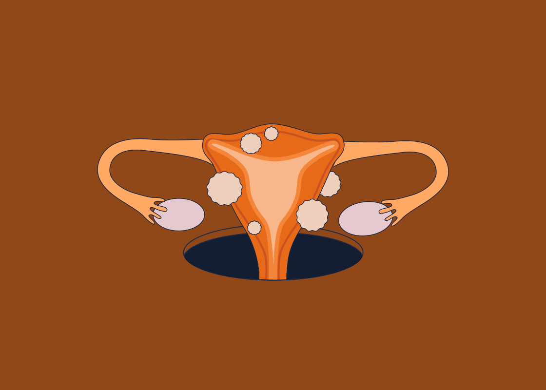 Uterine Fibroids Causes Symptoms And Treatment